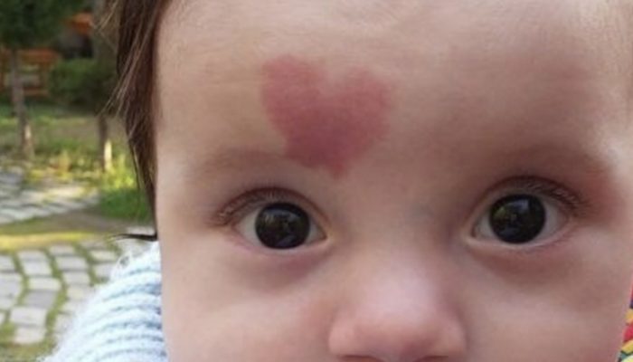 A baby with a heart-shaped birthmark was born in 2015. And, this is how ...
